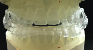 TMJ Oral Appliances | TMJ Specialist NYC | The Gelb Center